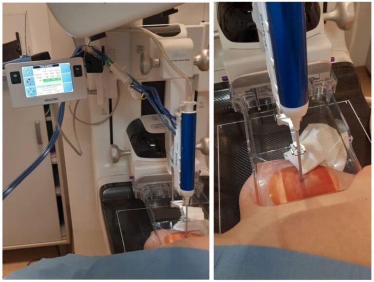 Vakuum asistirana biopsija: Revolucionarna metoda dijagnostike raka dojke